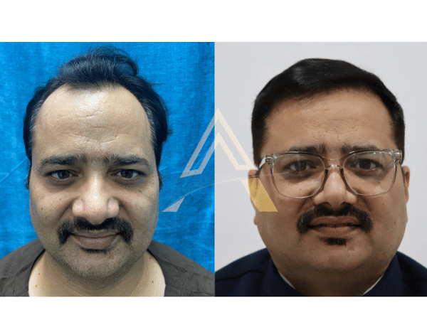 Dr Alok Sahoo, MD (AIIMS) to launch a new hair transplant clinic in ...