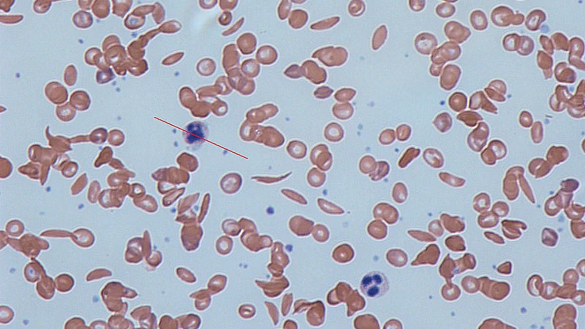 ‘Genetic scissors’ — India using same tech to find sickle cell cure as ...